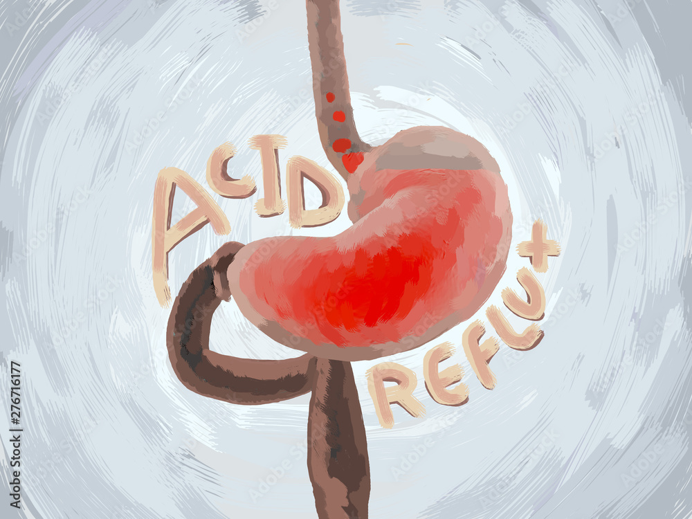 Acid reflux, GERD. Gastroesophageal reflux disease. Stomach and ...