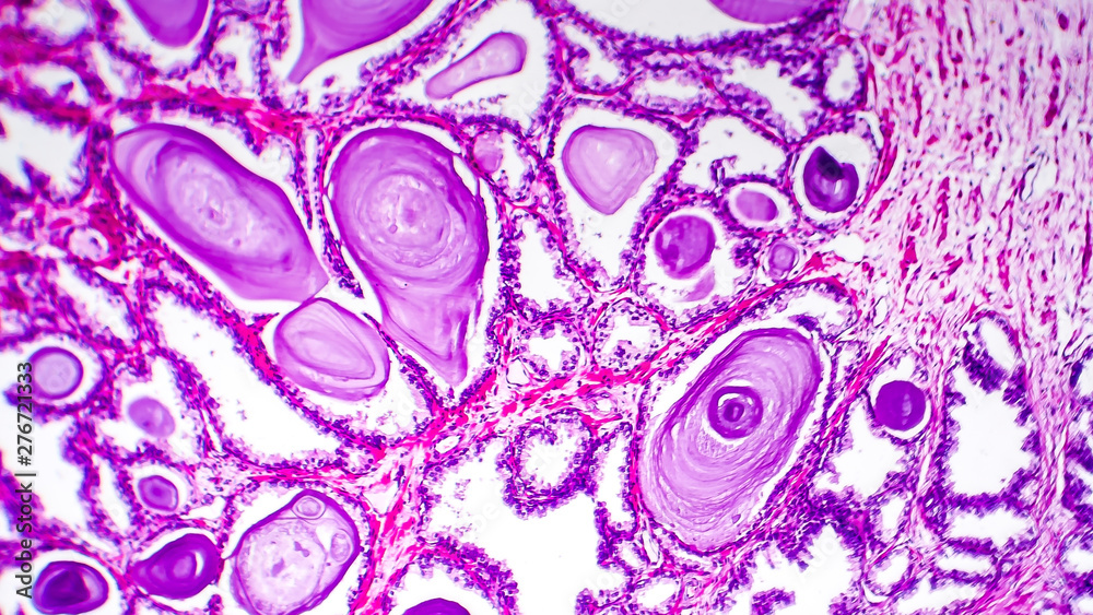 Histopathology of prostate gland hyperplasia, light micrograph, photo ...