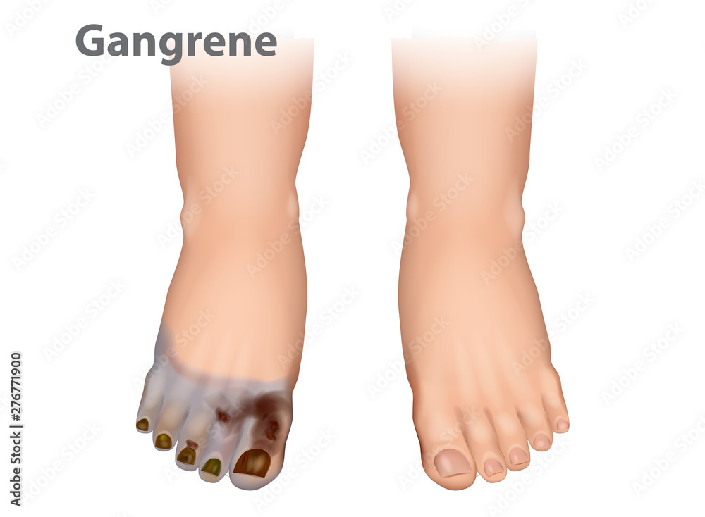 Gangrene is a type of tissue death caused. Diabetic Arterial Disease ...