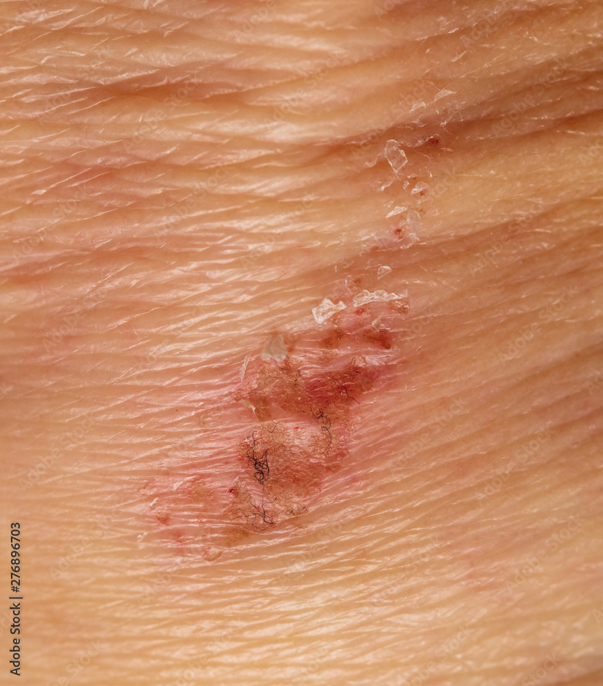 Wound on human skin as a background Stock Photo | Adobe Stock