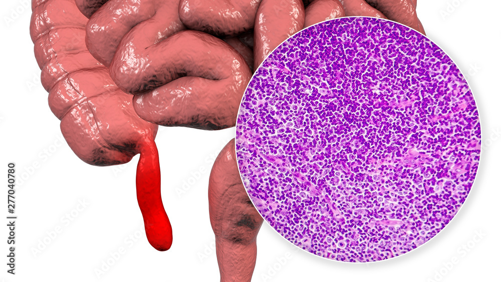 Acute suppurative appendicitis, 3D illustration of human intestine with ...