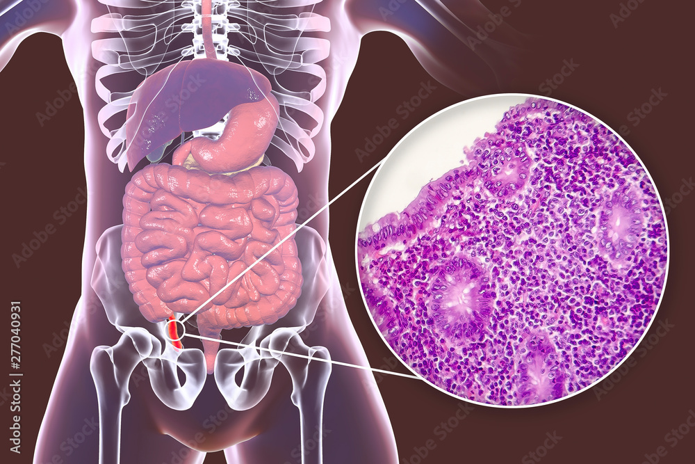 Acute suppurative appendicitis, 3D illustration of human body with ...