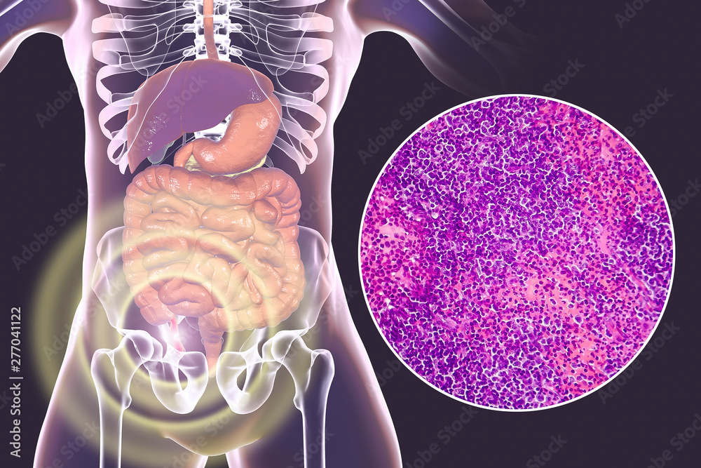 Acute suppurative appendicitis, 3D illustration of human body with ...