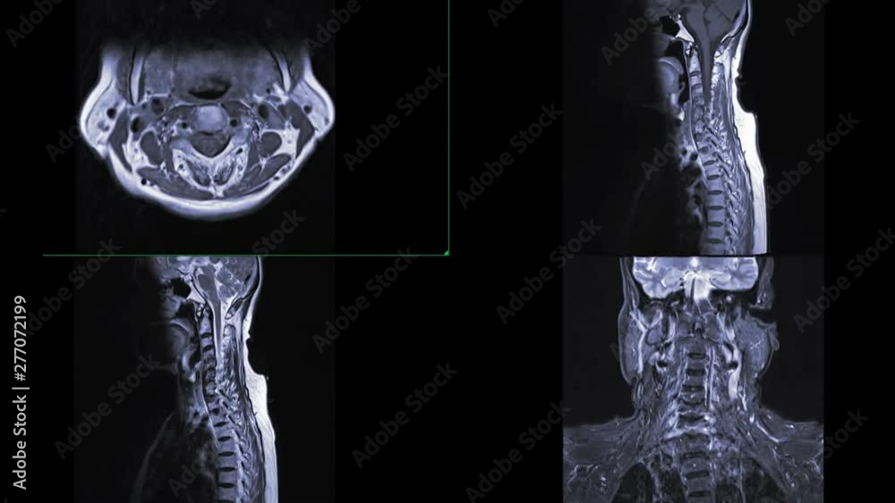 Comparison of MRI C-spine or magnetic resonance image of cervical spine ...