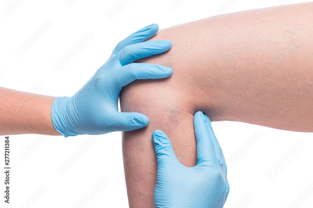 doctor and patient with varicose veins on the leg, close-up medical ...