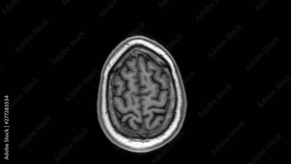 Slow-motion healthy human male caucasian top-down brain scan using FMRI ...