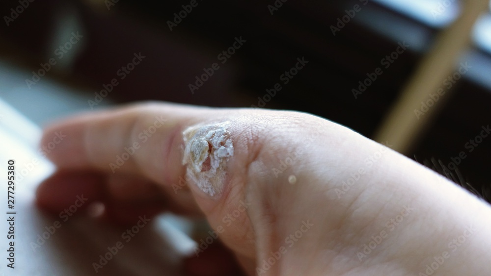 Wart Removal On Finger