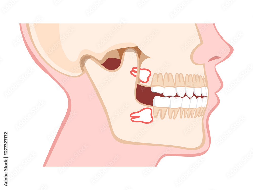 Human jaw with wisdom teeth side view Stock Vector | Adobe Stock