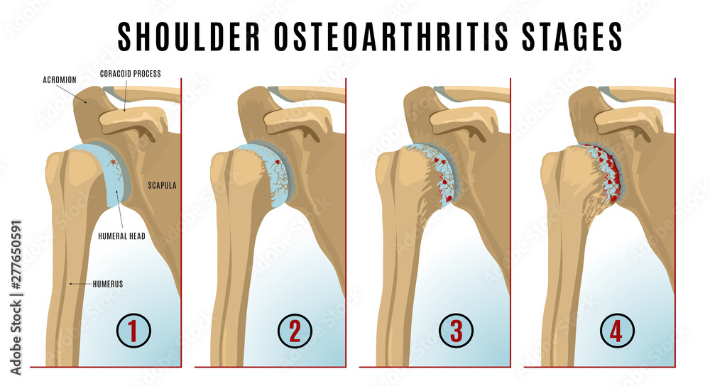 Shoulder osteoarthritis infographic Stock Vector | Adobe Stock