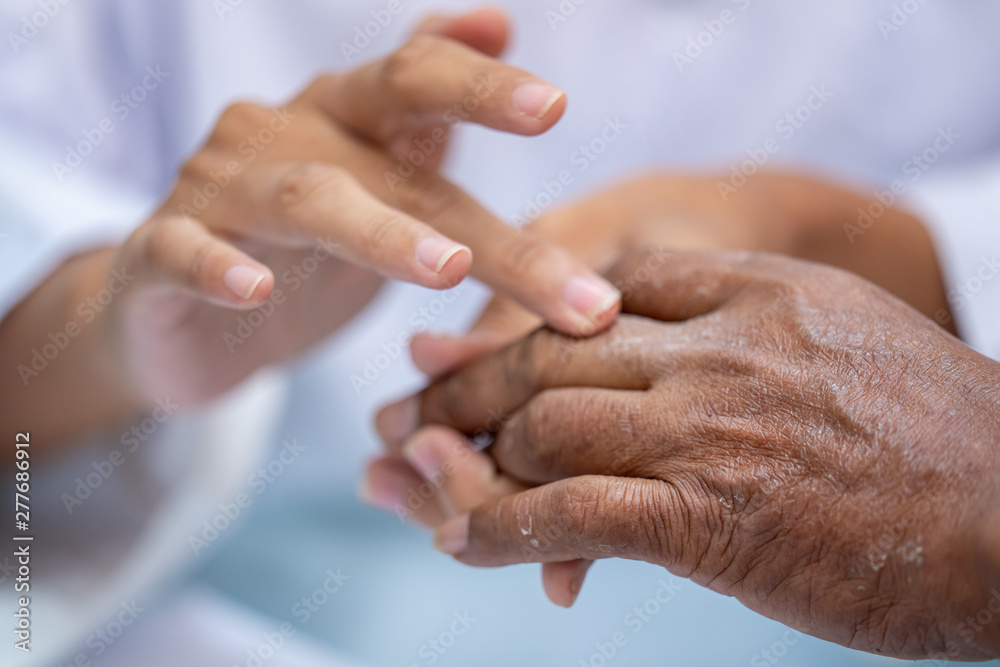 Selective focus close up man hand with dry itchy skin conditions ...