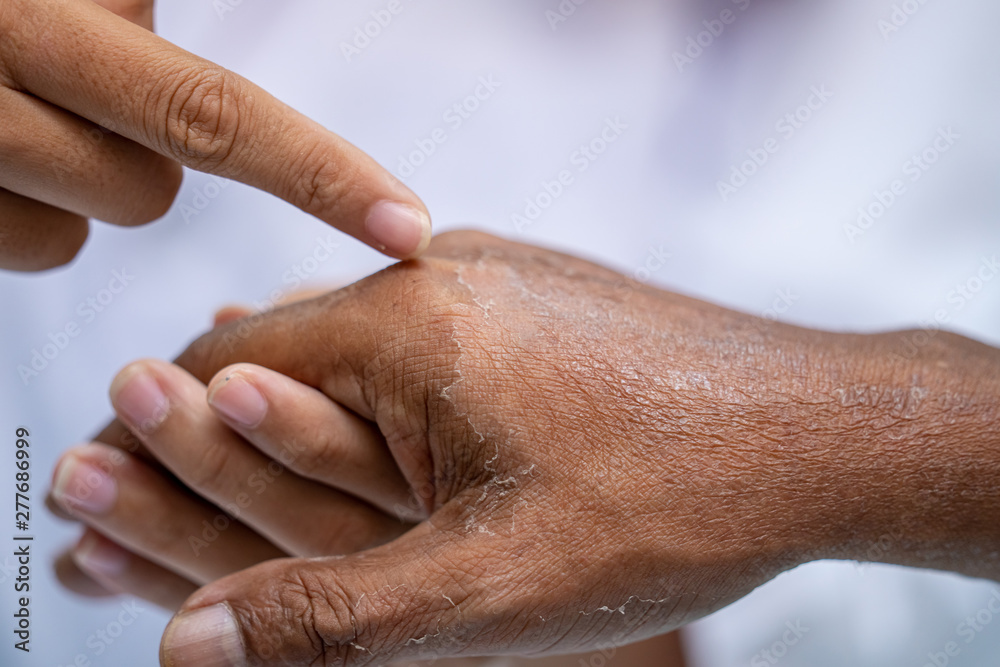 Selective focus close up man hand with dry itchy skin conditions ...