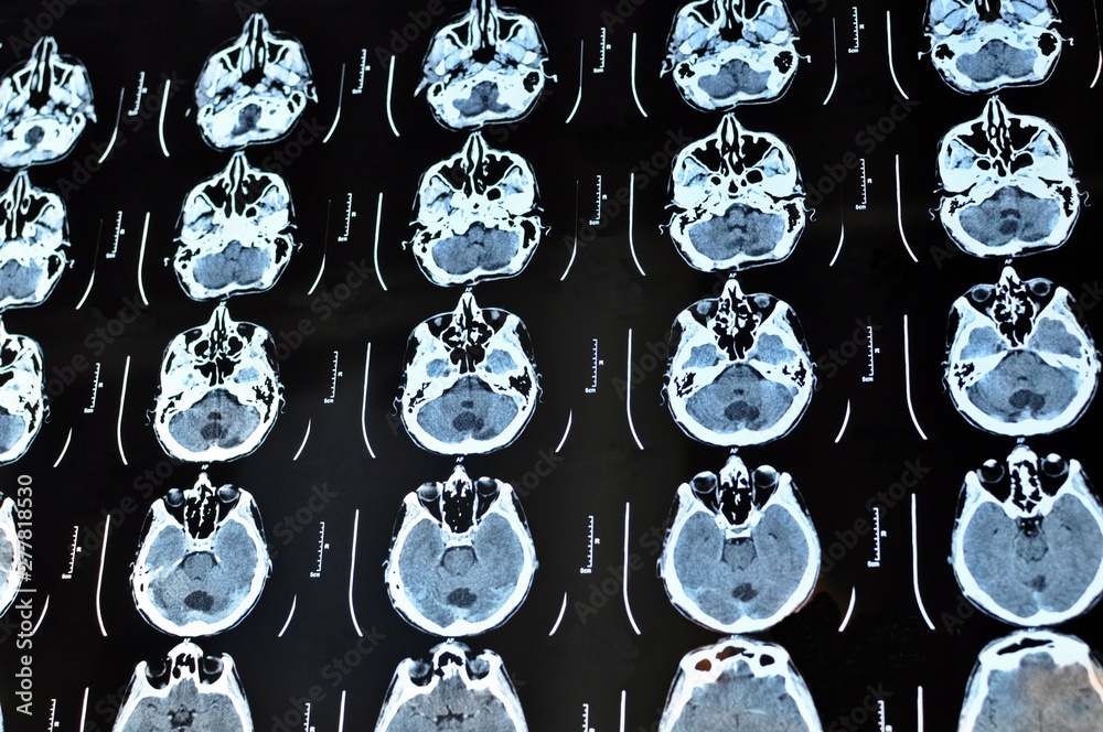 Computed tomography image scan of the brain. CT film of a human skull ...