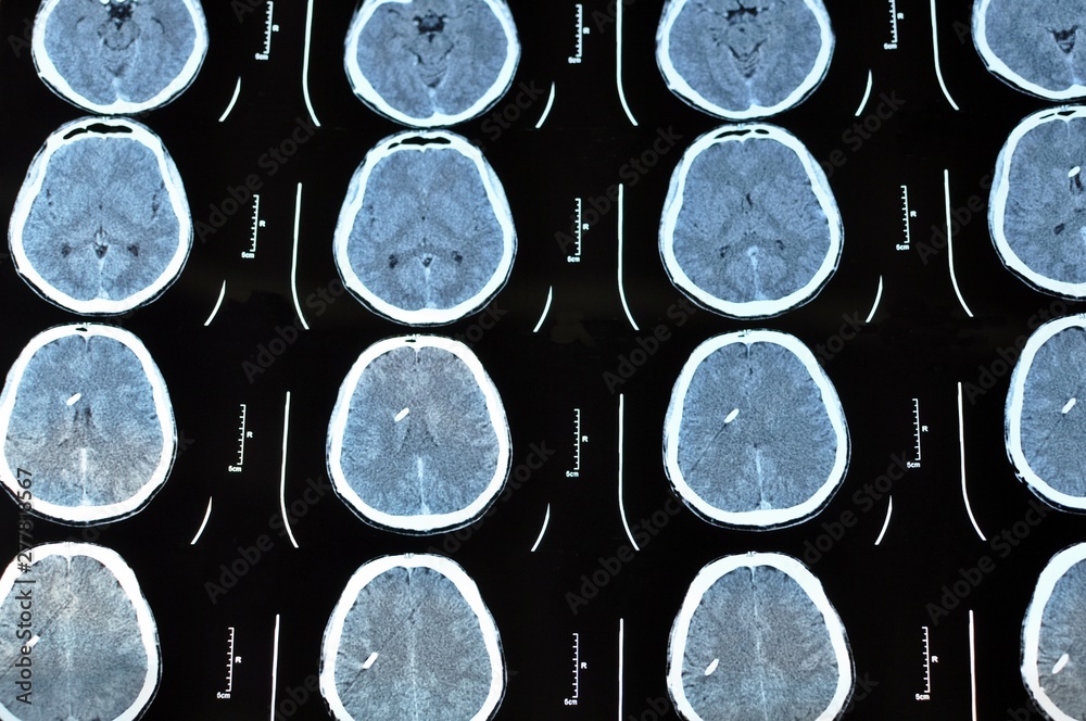 Computed tomography image scan of the brain. CT film of a human skull ...