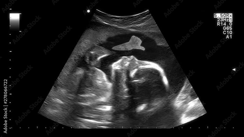Unborn baby gives thumbs up from the womb. Baby feels great ...