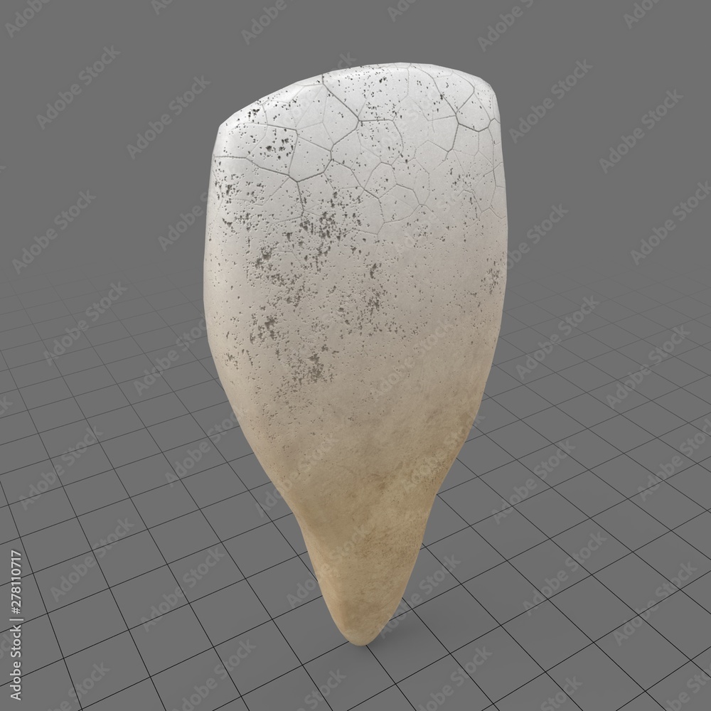 Tooth decay Stock 3D asset | Adobe Stock
