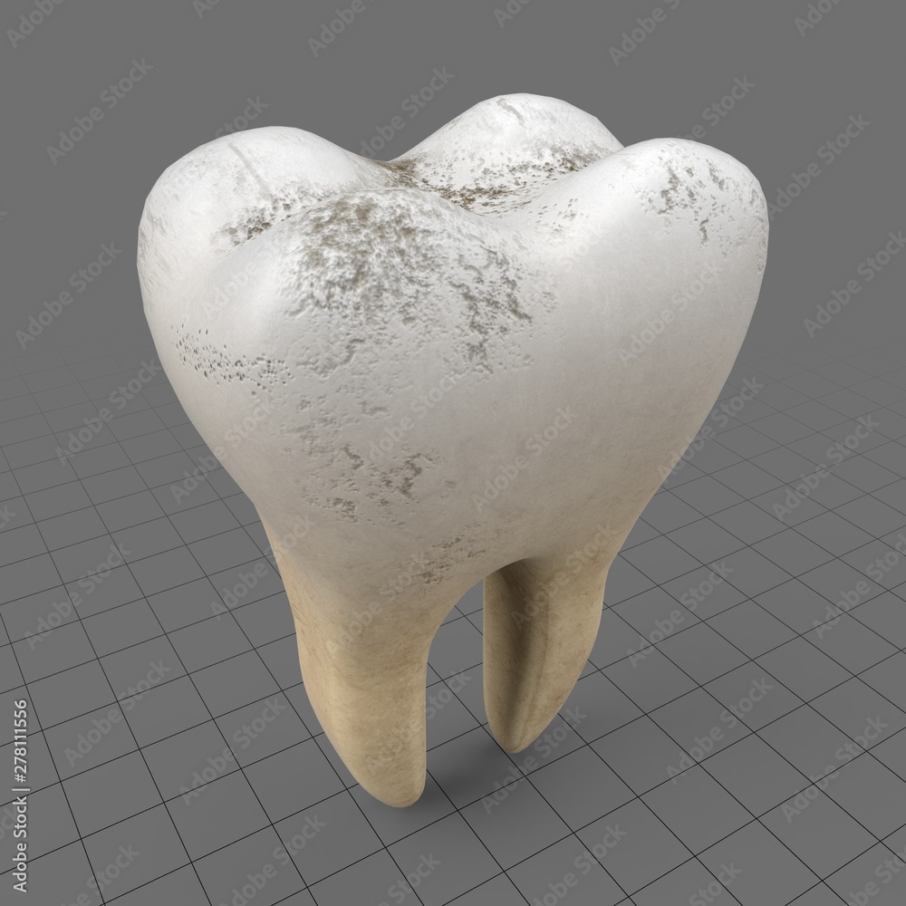 Wisdom tooth decay Stock 3D asset | Adobe Stock