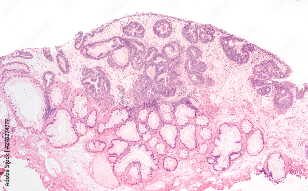 Microscopic image (photomicrograph) of cystitis glandularis of the ...
