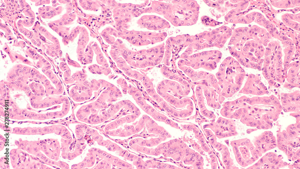 Thyroid gland cancer awareness: Microscopic image of papillary thyroid ...