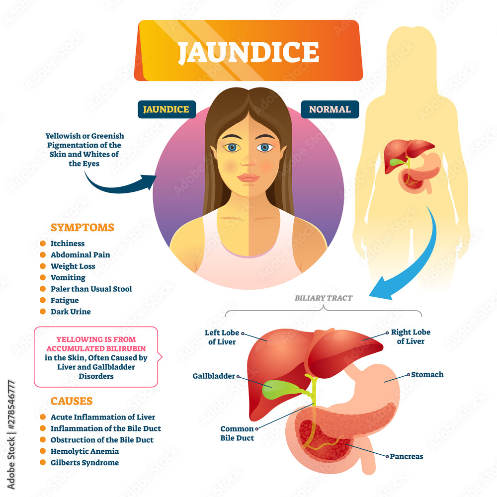 Jaundice or icterus vector illustration. Labeled yellowish disease ...