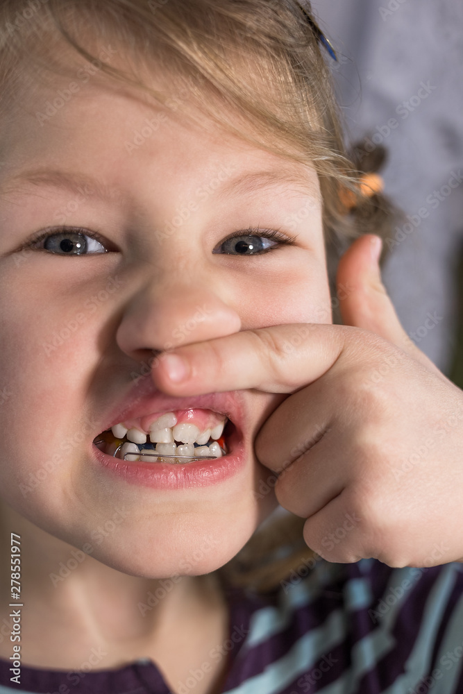 Adult permanent teeth coming in front of the child's baby teeth: shark ...