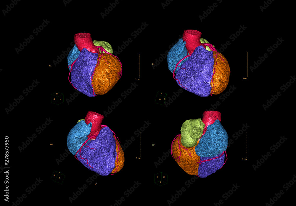 Multi view of CTA Coronary artery 3D rendering image for detect ...