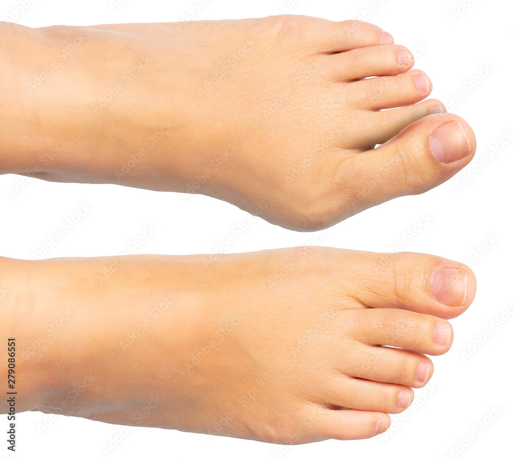 A closeup view on the sore and painful feet of a Caucasian person ...