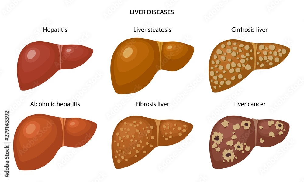 Alcoholic Hepatitis Liver