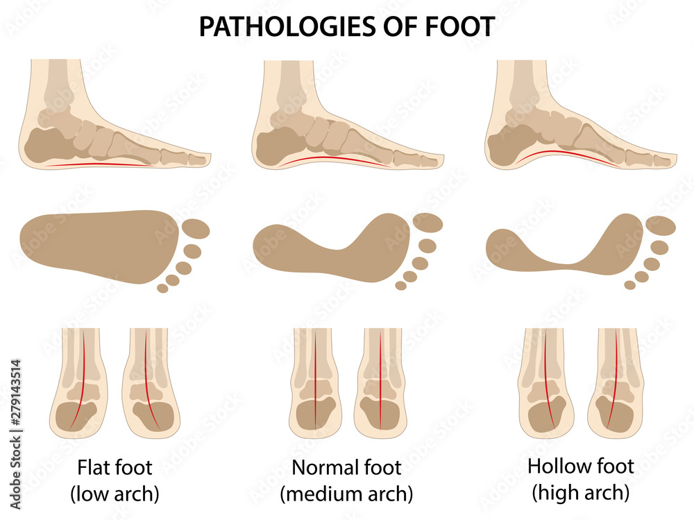 Póster Pathologies of foot – Cuadro para Pared | Posters.es