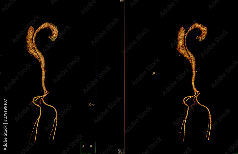 Computer tomography angiography :CTA of whole body scan with 3D ...