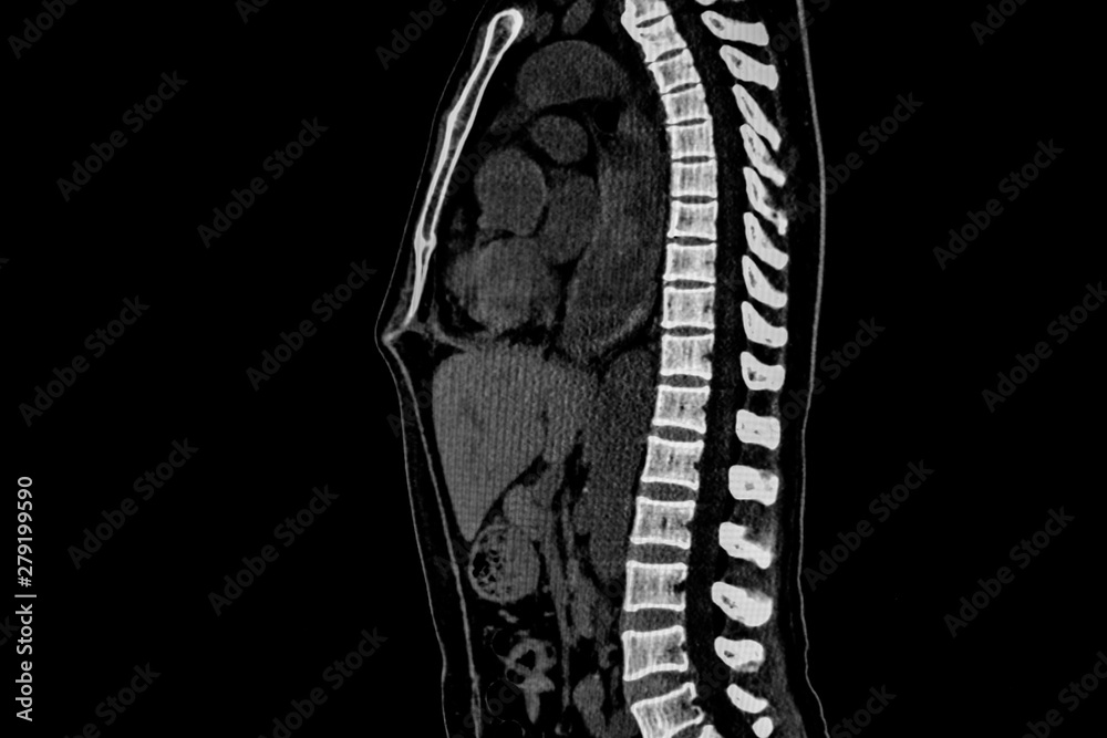 Computer tomography angiography :CTA of whole body scan with 3D ...