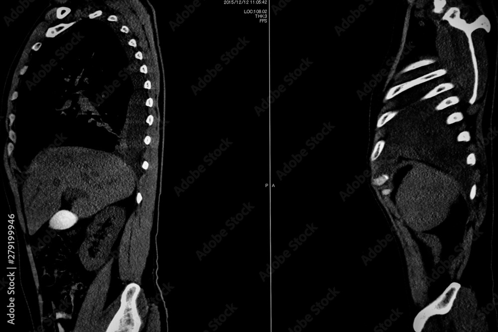 Foto de Computer tomography angiography :CTA of whole body scan with 3D ...