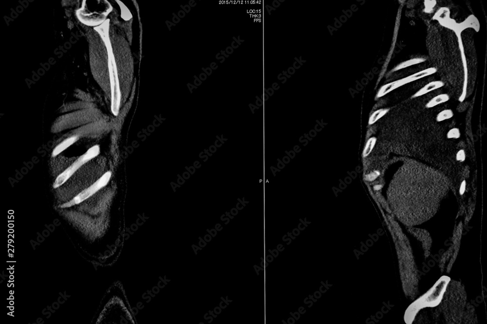 Computer tomography angiography :CTA of whole body scan with 3D ...