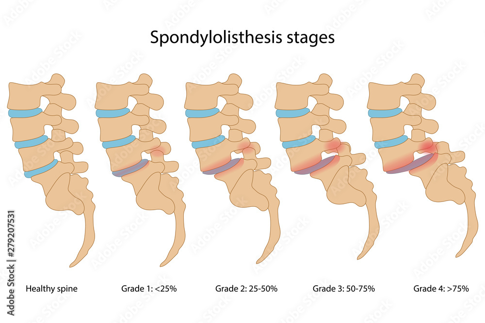 Spondylolisthesis stages with main description. Healthy spine and spine ...