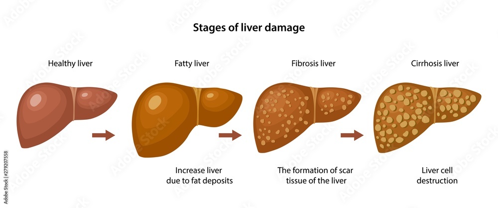 Stages of liver damage with description corresponding steps: healthy ...