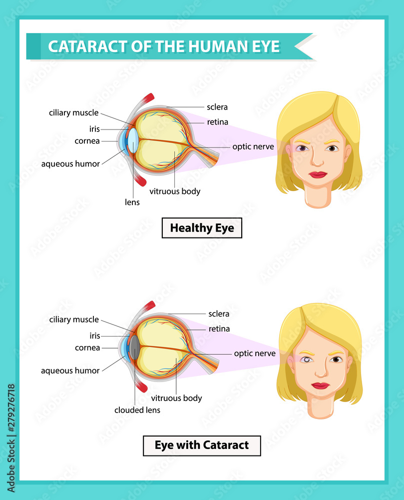 Eyeball Medical Illustration