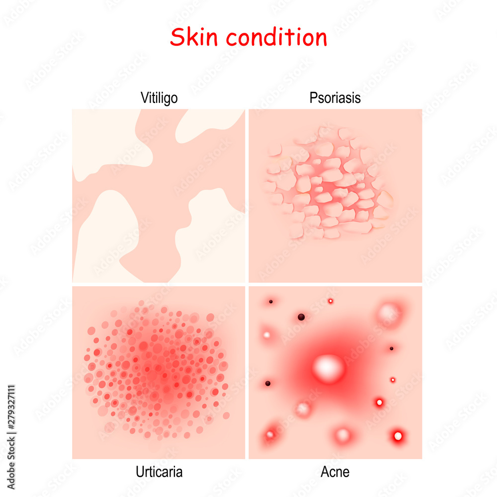Skin condition and diseases. Close-up of Acne, Urticaria, Psoriasis ...