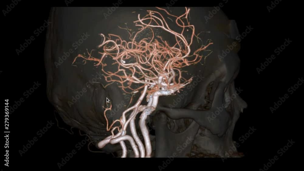 CTA Brain or computed tomography angiography of the brain 3D Rendering ...