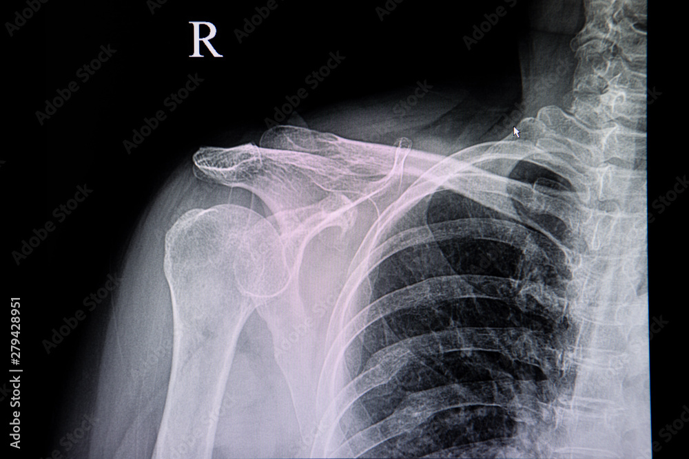 chest xray of a patient with old ribs fracture Stock Photo | Adobe Stock