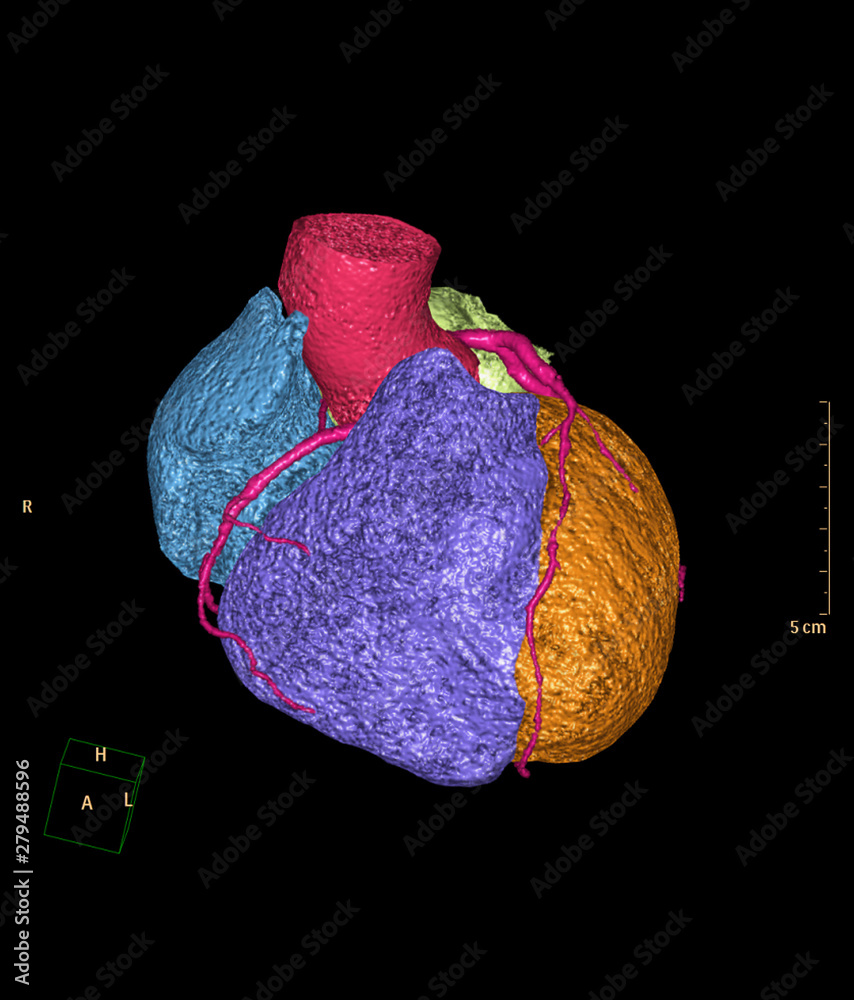 CTA Coronary artery 3D rendering image for detect coronary artery ...