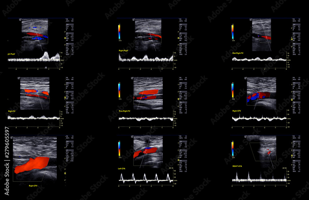 Ultrasound doppler for finding deep vein thrombosis of lower extremity ...