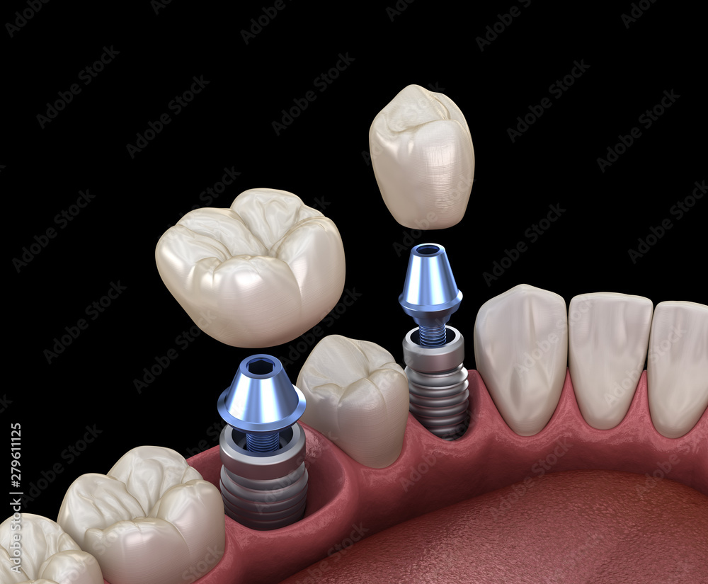 Premolar And Molar Tooth Crown Installation Over Implant Concept 3d 2556