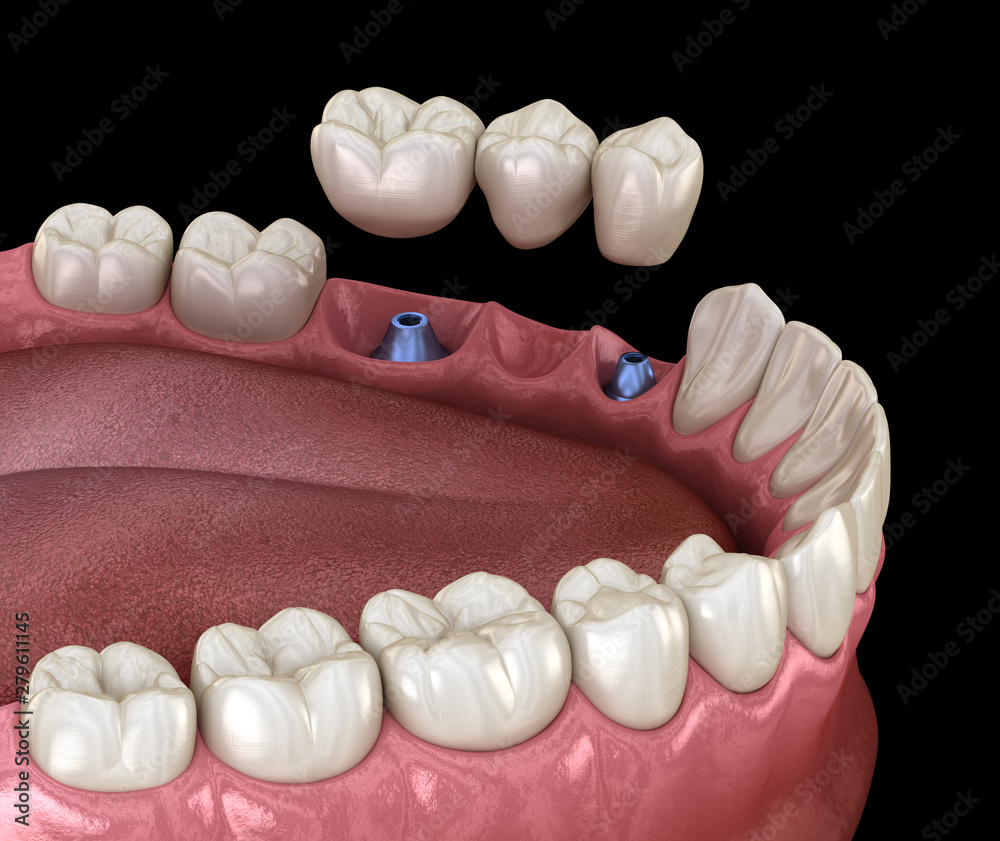 Dental bridge supported by implants. Medically accurate 3D illustration ...