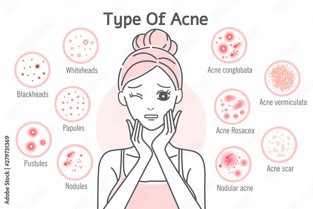 Acne Nodules On Face