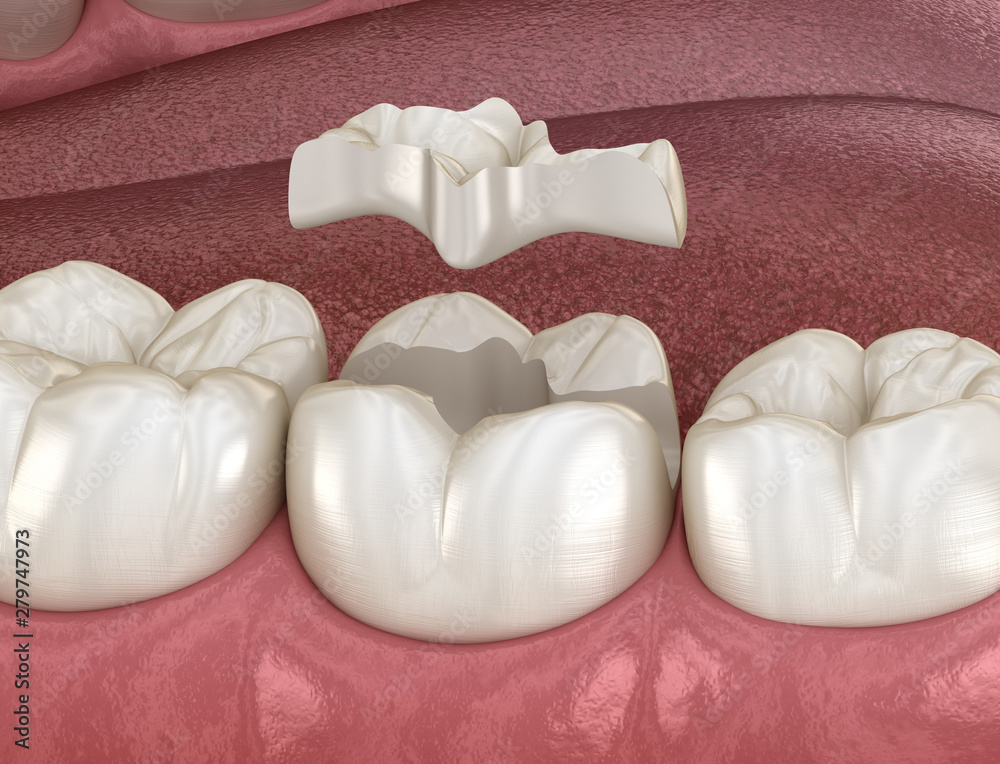 Inlay ceramic crown fixation over tooth. Medically accurate 3D ...