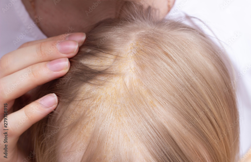 Seborrheic skin rash on the child s head, seborrheic dermatitis, close ...