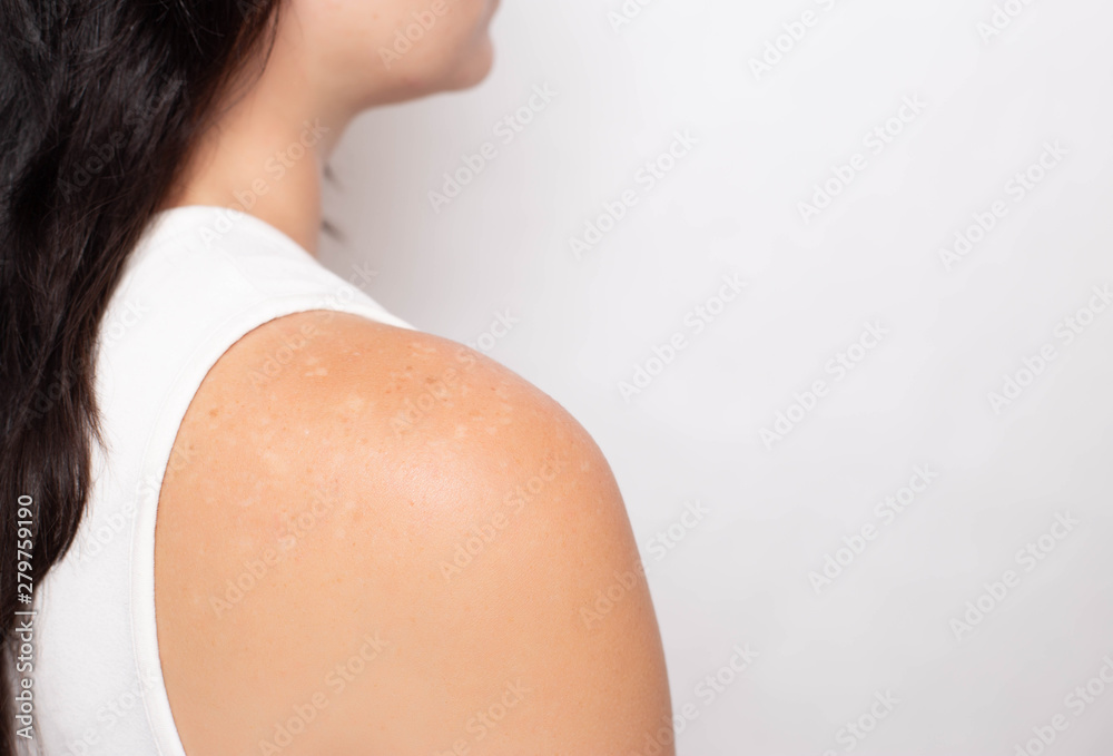 Problem skin with pigmented spots on the girl s shoulder on a white ...