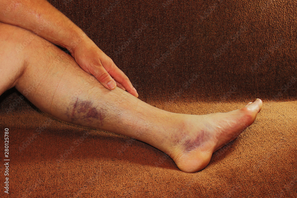 Ankle Bruises Ankle Bruises
