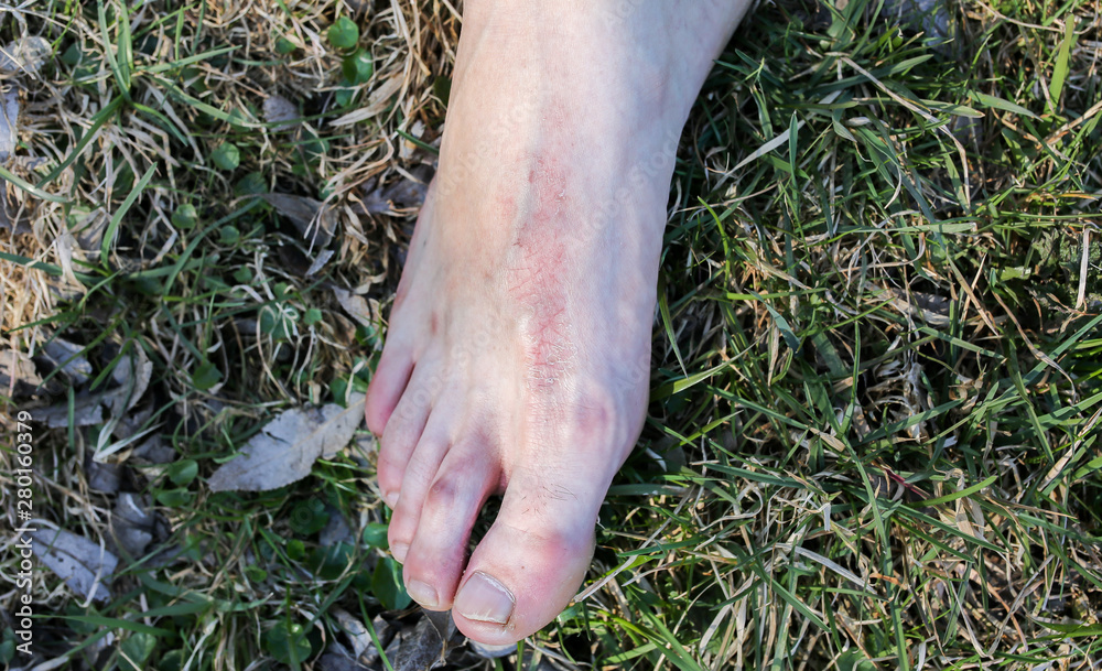 Man's leg with dermatitis. Person sitting in the nature. Barefoot on ...