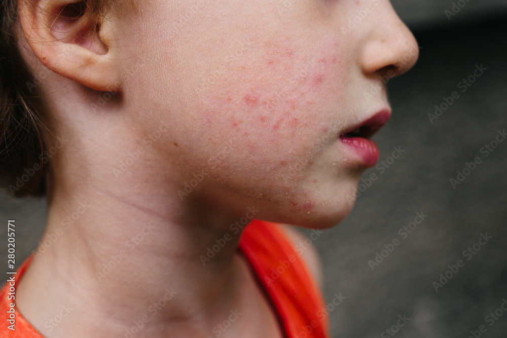Food allergies in children. baby with dermatitis problem rash. Close-up ...