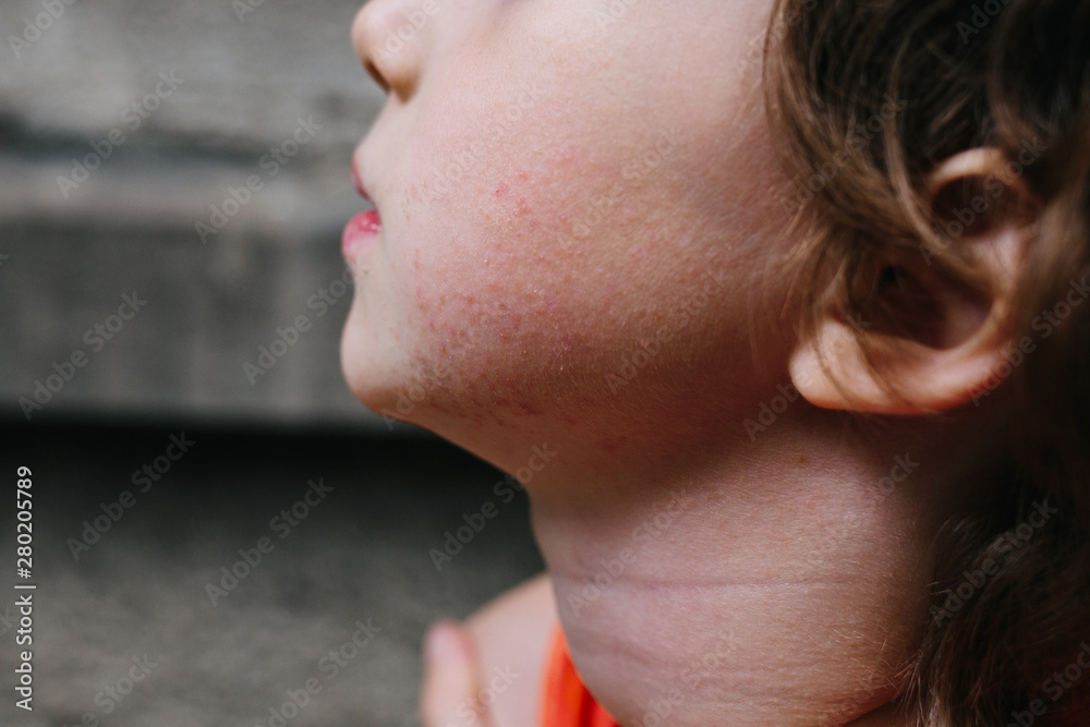 Food allergies in children. baby with dermatitis problem rash. Close-up ...
